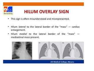 SIGNS CXR | PPT