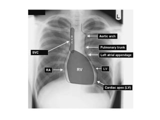 SIGNS CXR | PPT