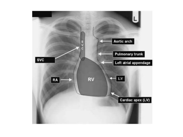 SIGNS CXR | PPT