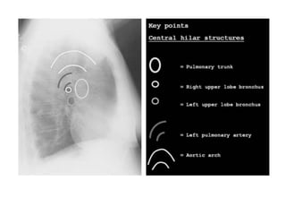 SIGNS CXR | PPT