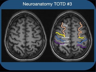 Signs in Central Sulcus of brain- common pathologies .pptx