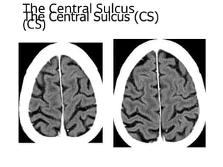 Signs in Central Sulcus of brain- common pathologies .pptx