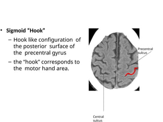 Signs in Central Sulcus of brain- common pathologies .pptx