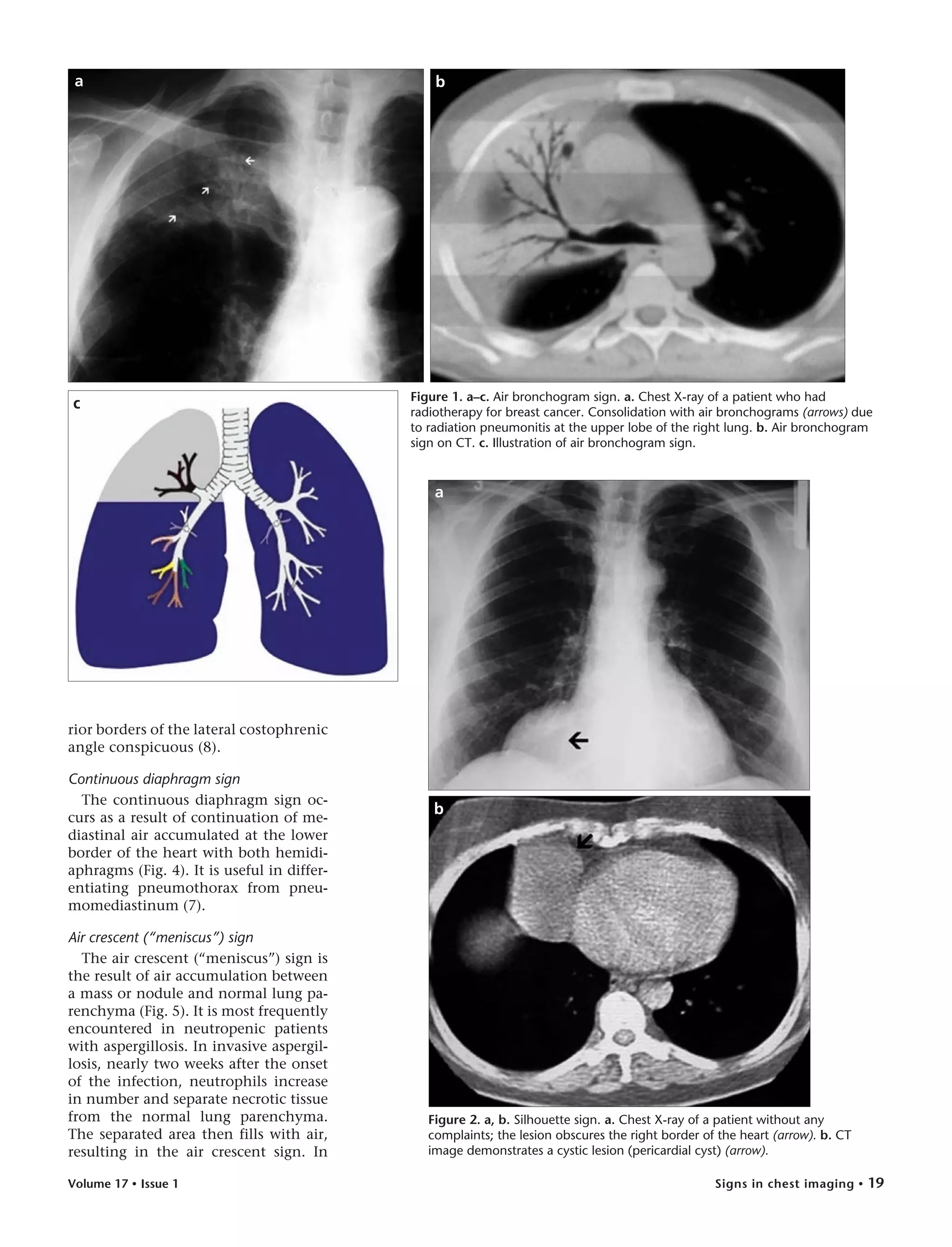 Signs in chest imaging | PDF