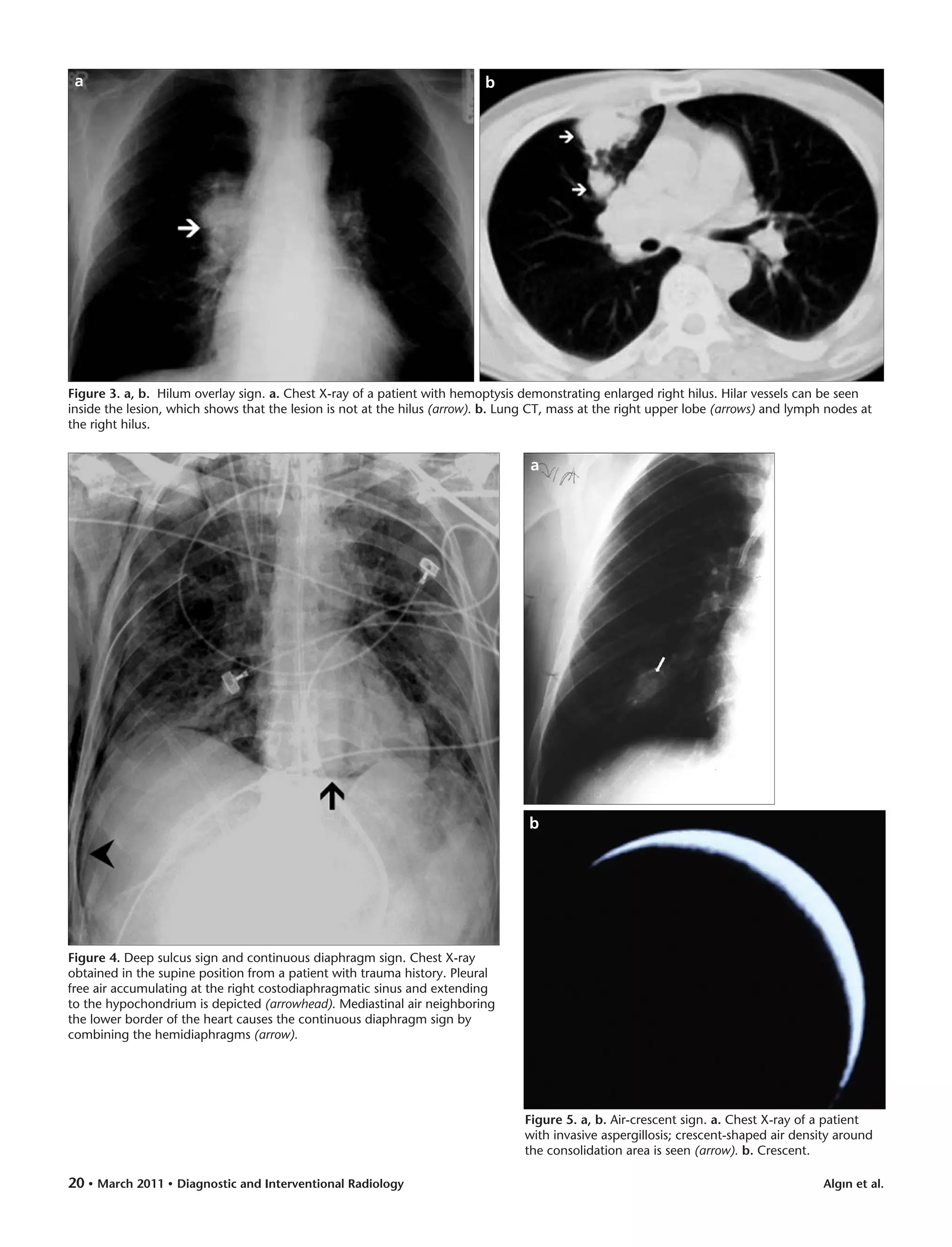 Signs in chest imaging | PDF
