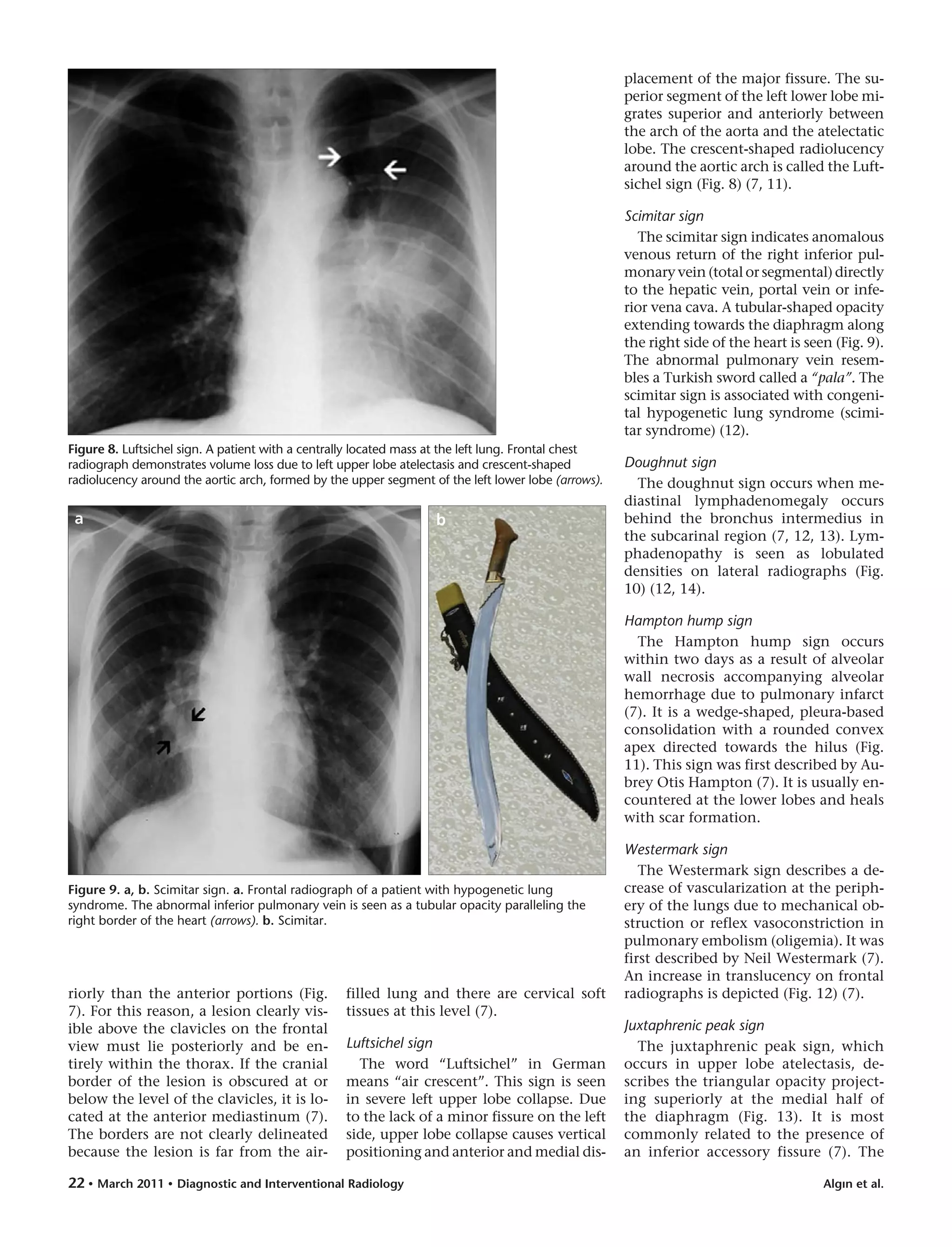 Signs in chest imaging | PDF