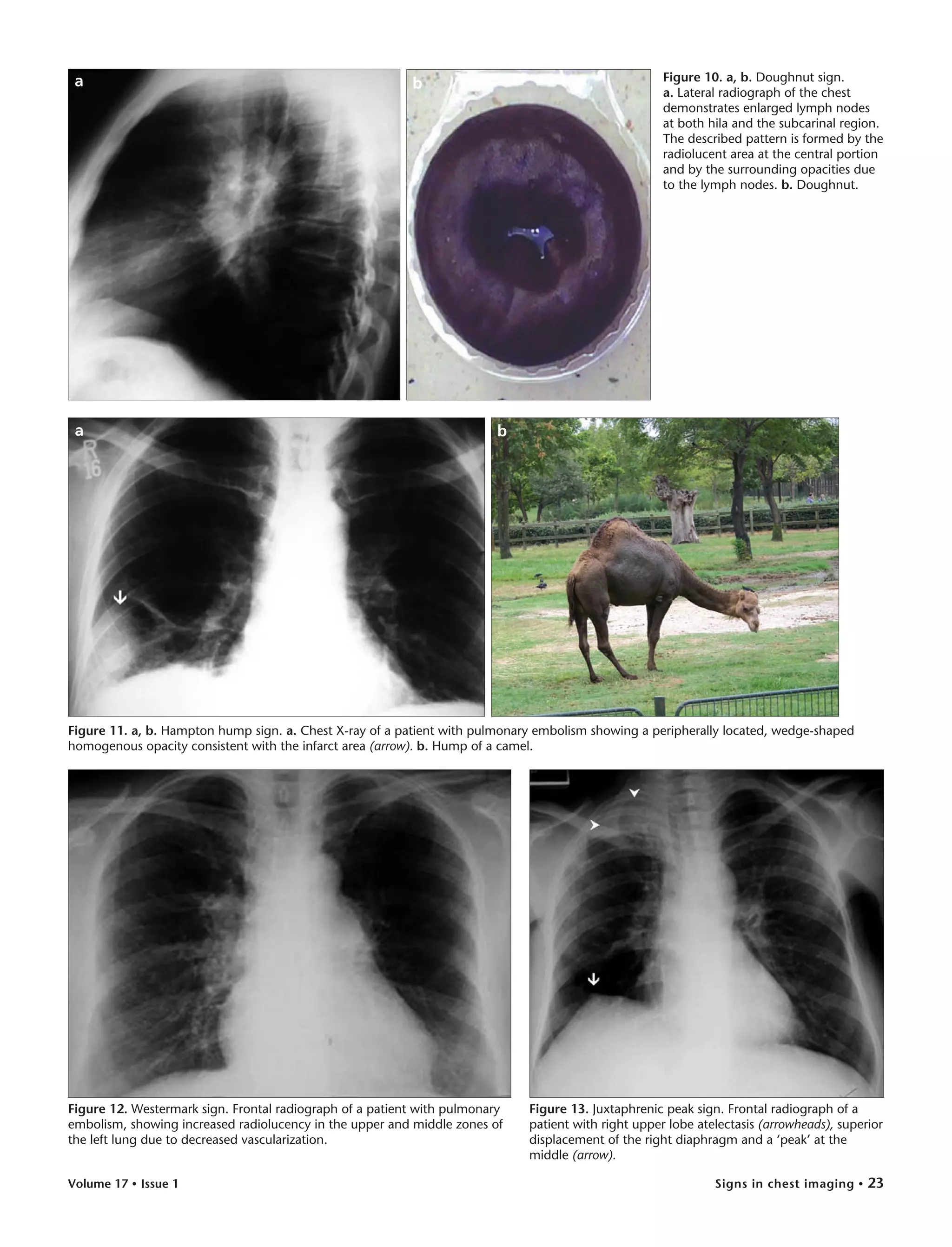 Signs in chest imaging | PDF