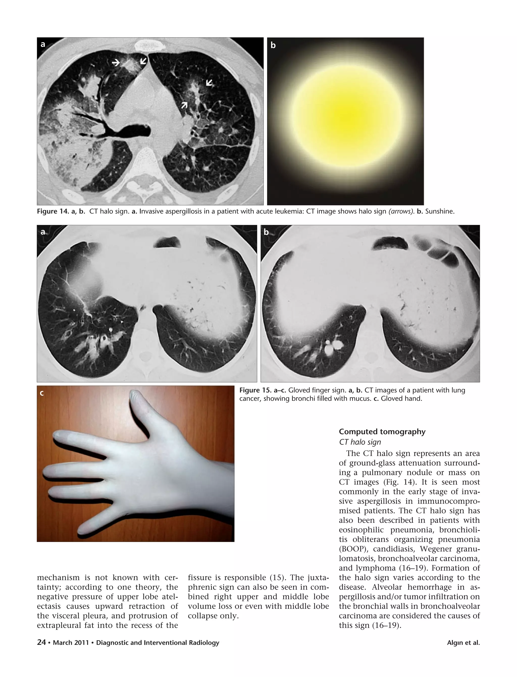 Signs in chest imaging | PDF