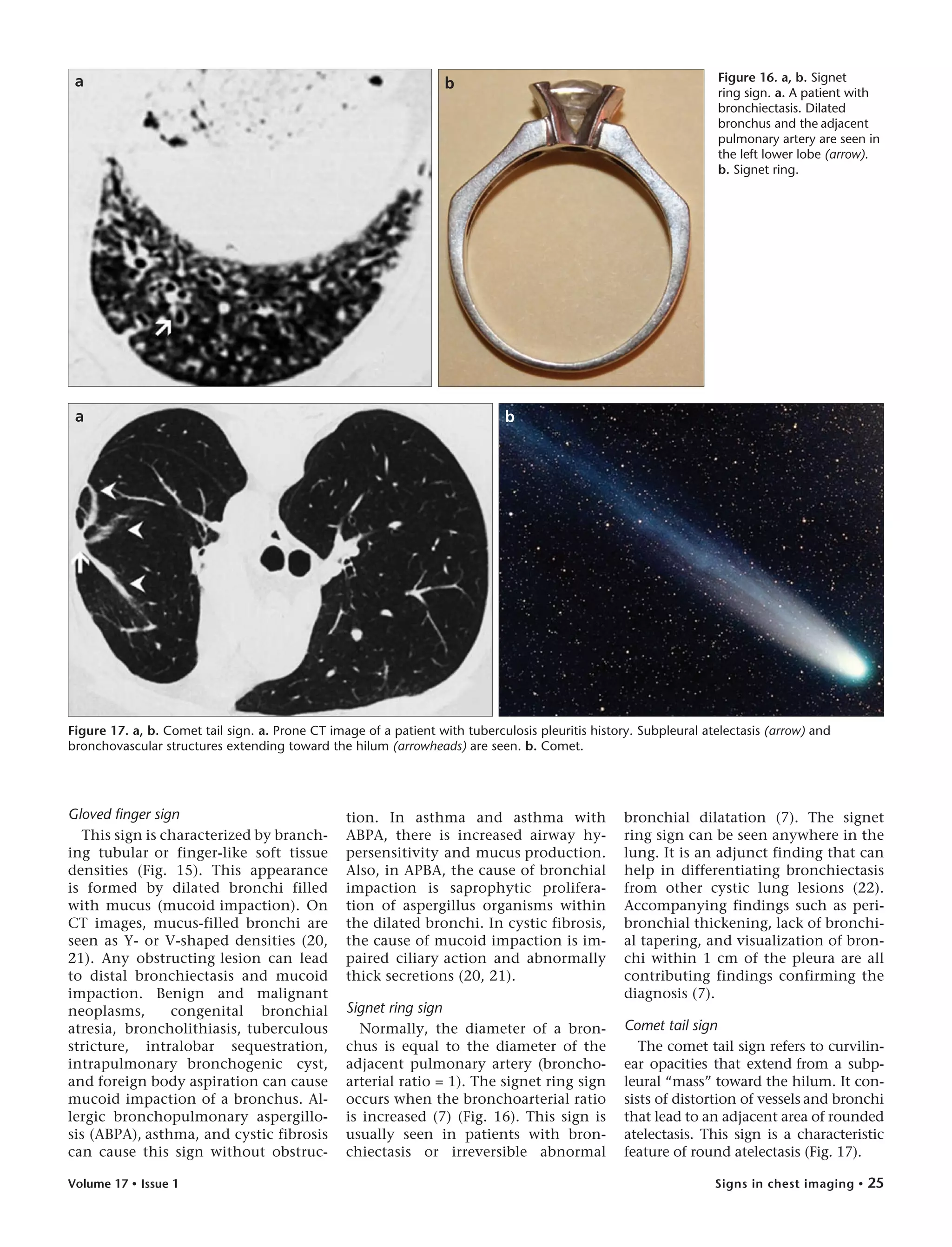 Signs in chest imaging | PDF