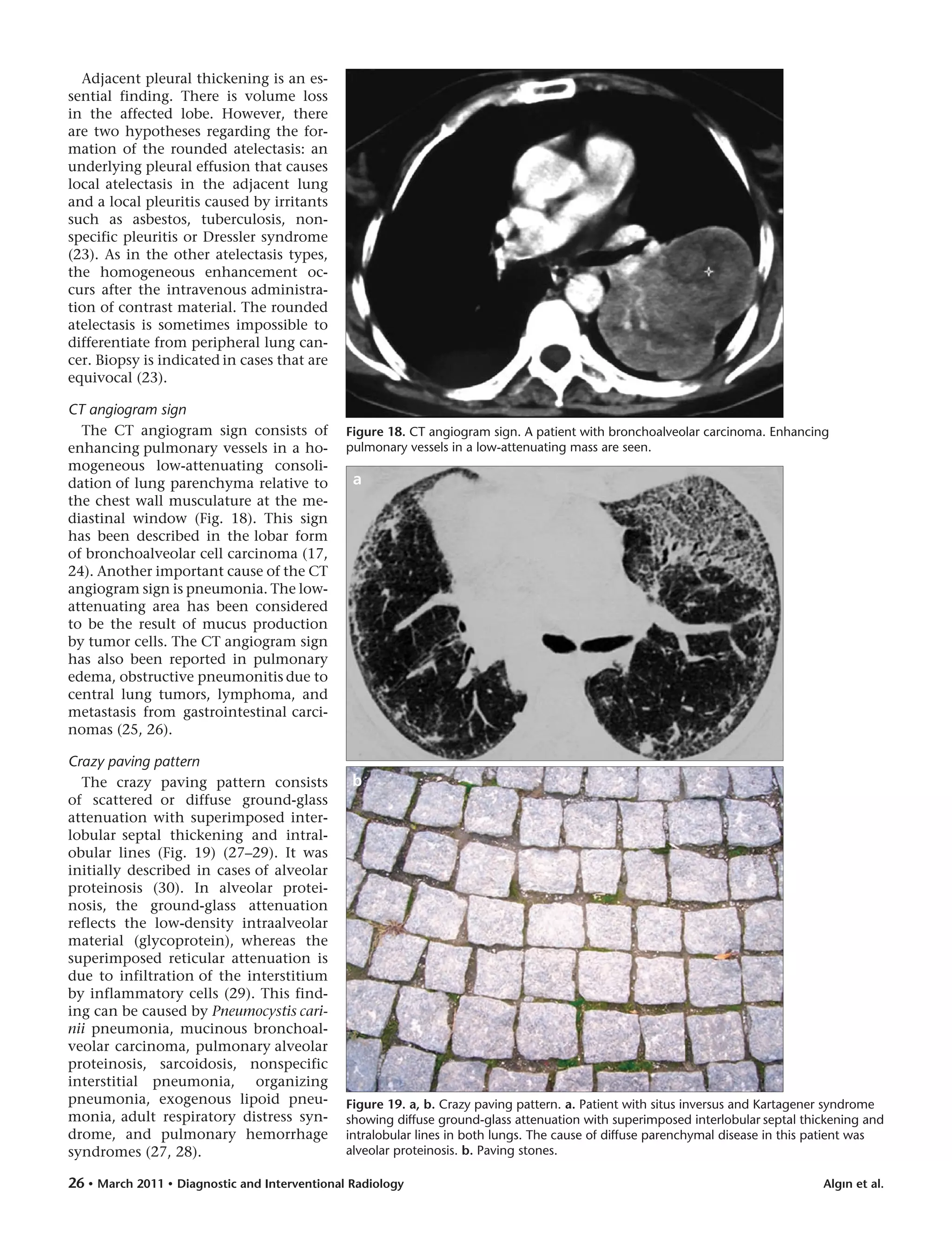 Signs in chest imaging | PDF