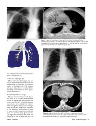Signs in chest imaging | PDF