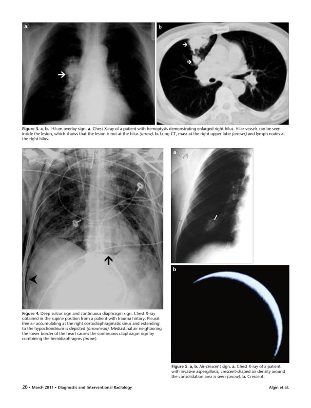 Signs in chest imaging | PDF | Lung and Respiratory Health | Diseases ...