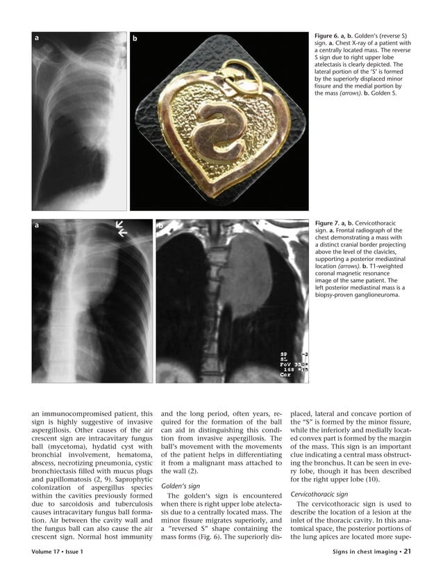 Signs in chest imaging | PDF