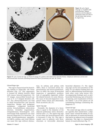 Signs in chest imaging | PDF