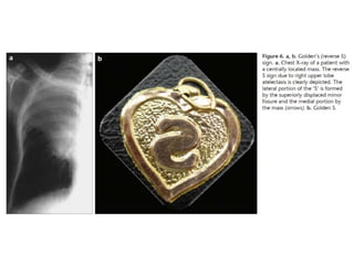 Signs in chest imaging | PPTX