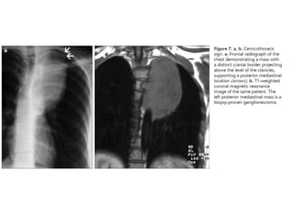 Signs in chest imaging | PPTX