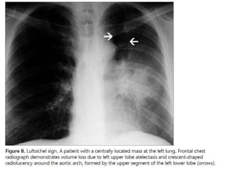 Signs in chest imaging | PPTX