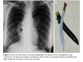 Signs in chest imaging | PPTX