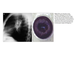 Signs in chest imaging | PPTX