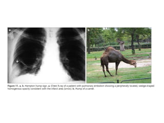 Signs in chest imaging | PPTX