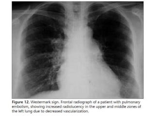 Signs in chest imaging | PPTX
