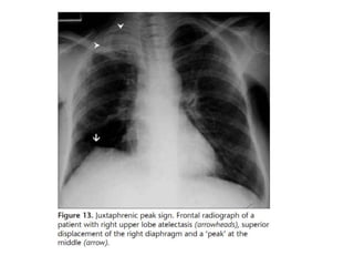 Signs in chest imaging | PPTX