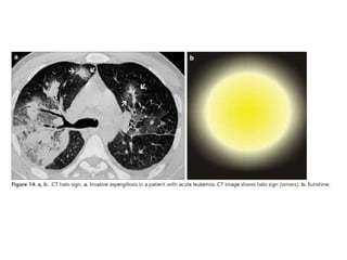 Signs in chest imaging | PPTX