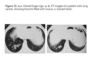 Signs in chest imaging | PPTX