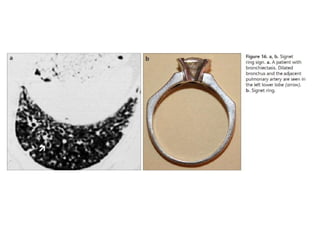 Signs in chest imaging | PPTX
