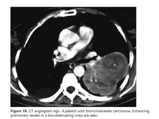 Signs in chest imaging | PPTX