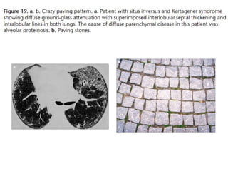 Signs in chest imaging | PPTX