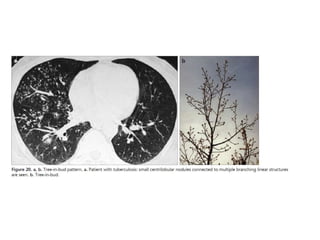 Signs in chest imaging | PPTX