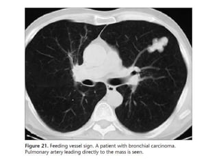 Signs in chest imaging | PPTX
