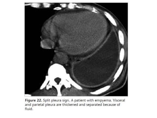 Signs in chest imaging | PPTX