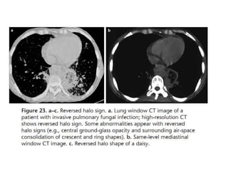 Signs in chest imaging | PPTX