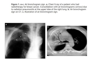 Signs in chest imaging | PPTX