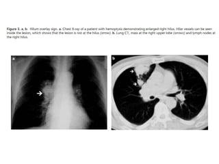 Signs in chest imaging | PPTX