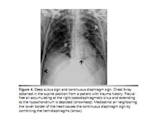 Signs in chest imaging | PPTX