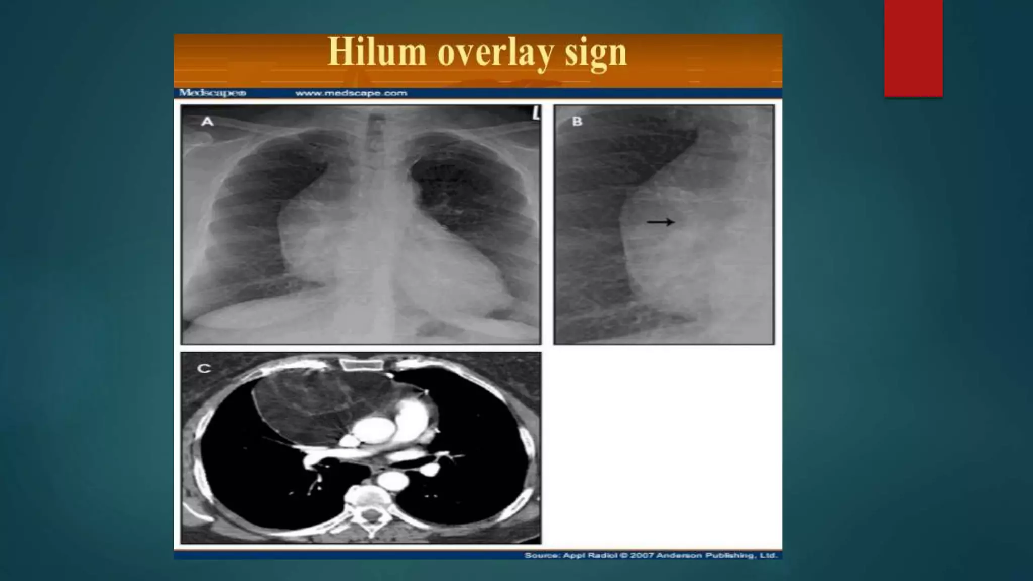 Signs in chest xray | PPTX