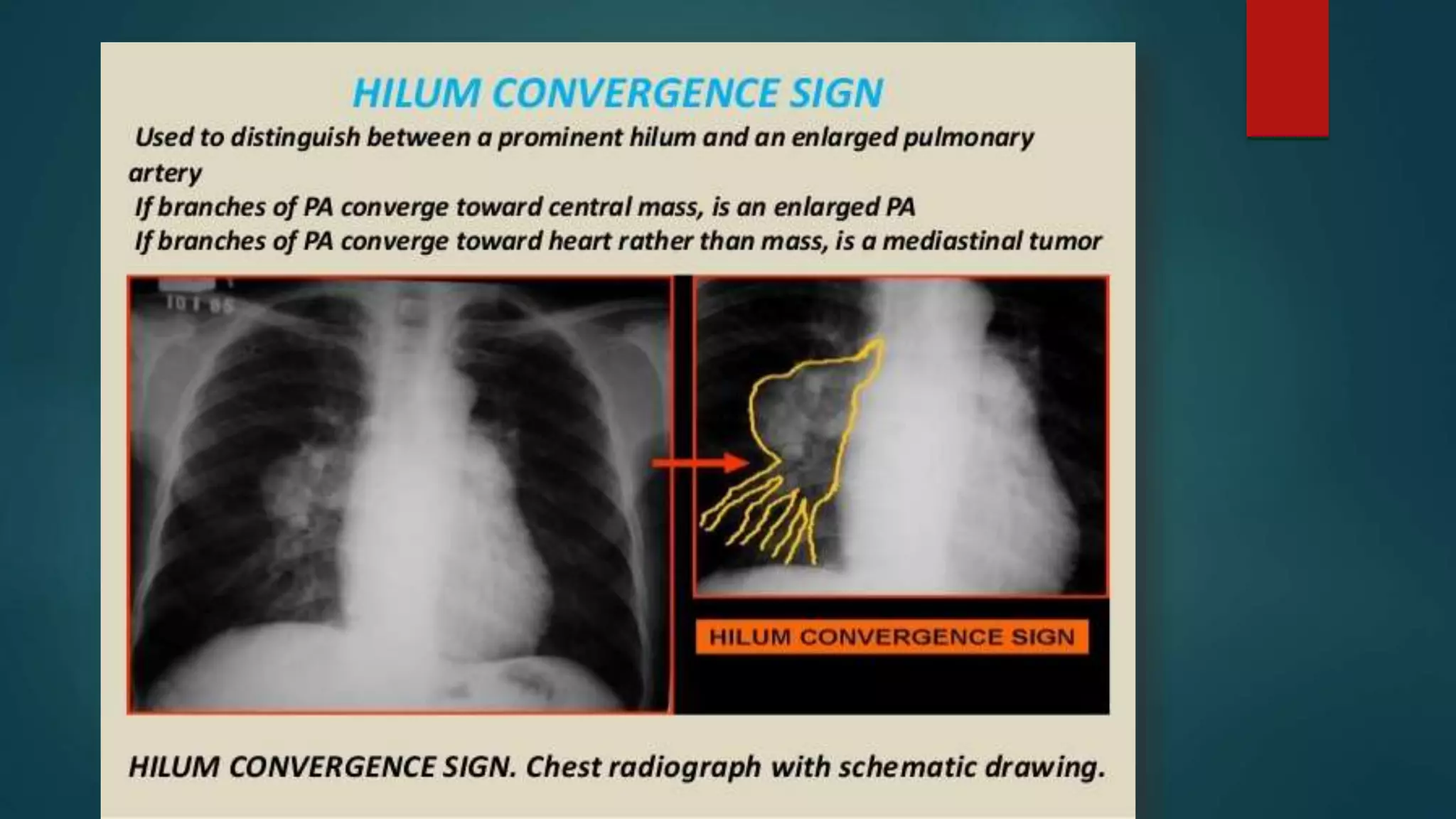 Signs in chest xray | PPTX