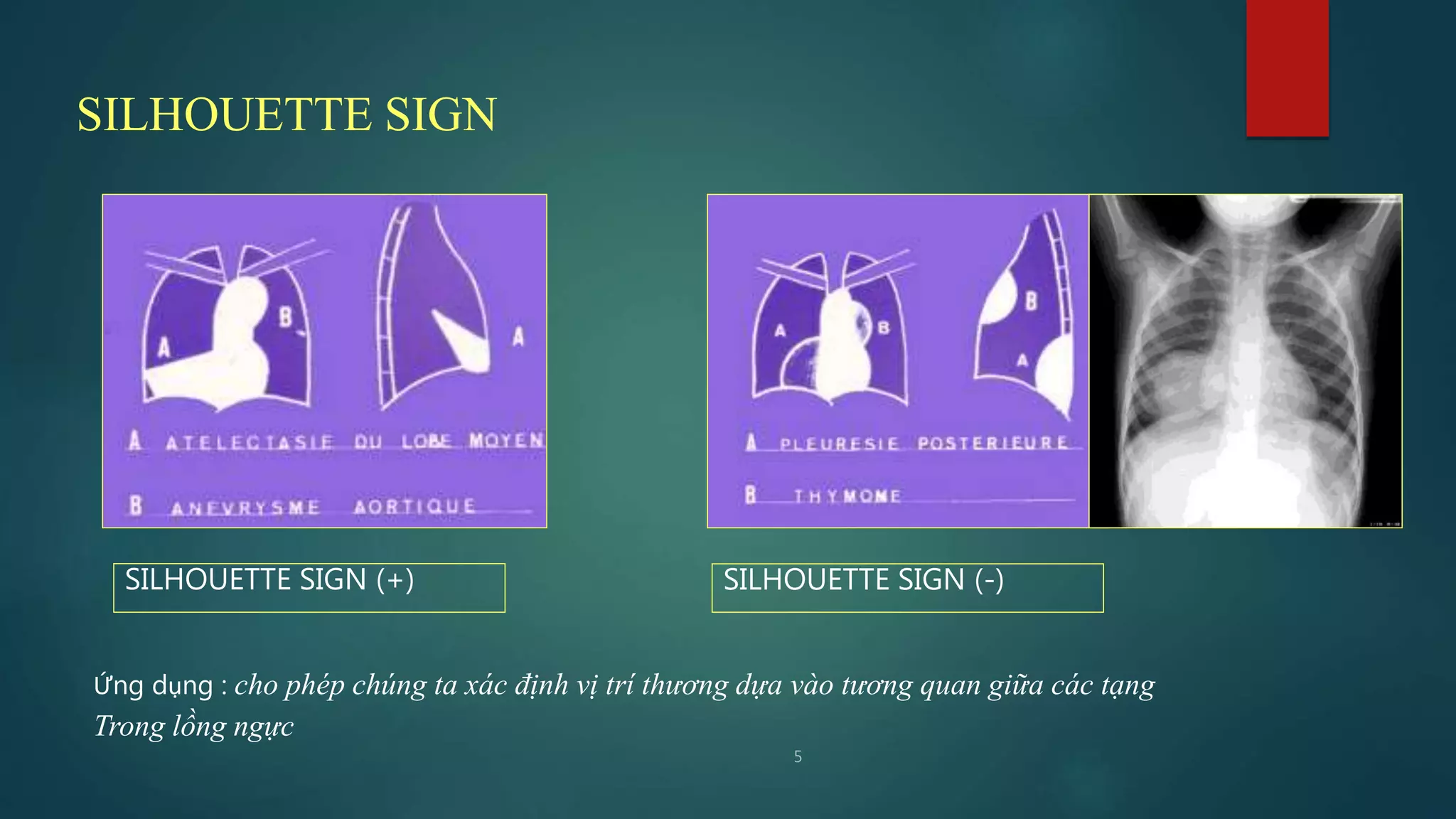 Signs in chest xray | PPTX