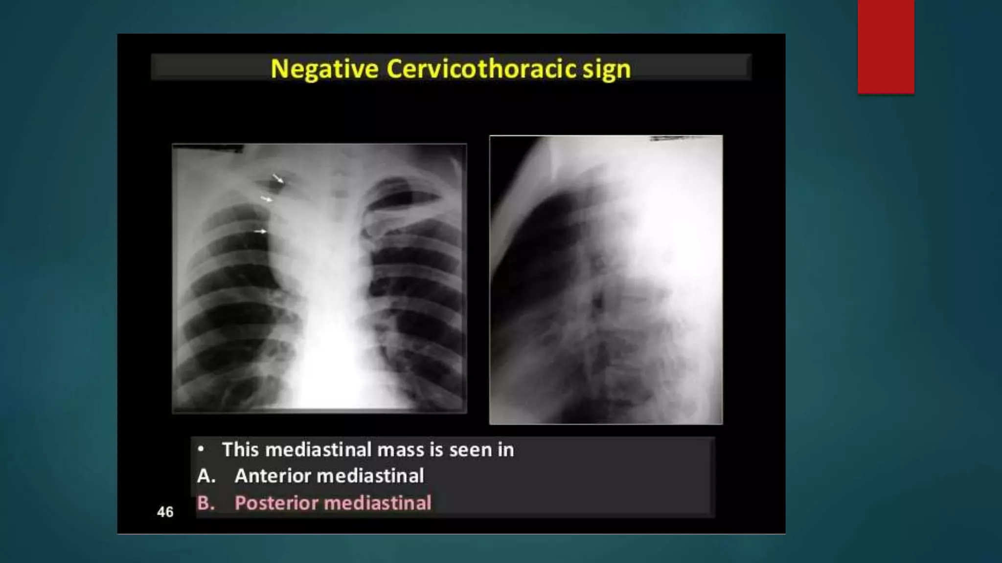 Signs in chest xray | PPTX