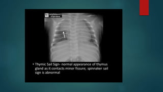 Signs in chest xray | PPTX