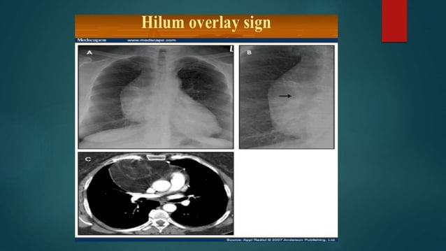 Signs in chest xray | PPT