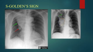 Signs in chest xray | PPTX