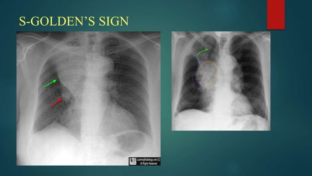 Signs in chest xray | PPT