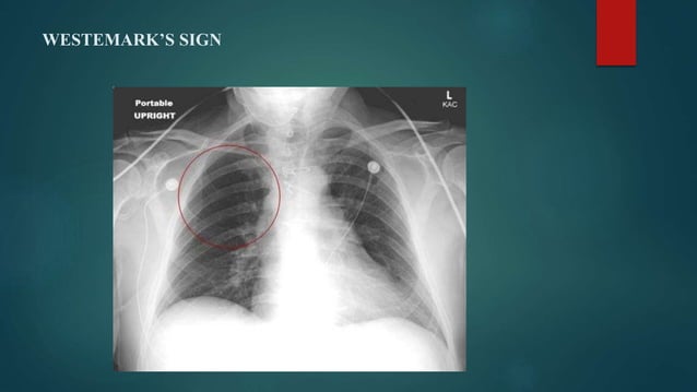 Signs in chest xray | PPT