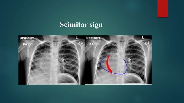 Signs in chest xray | PPT
