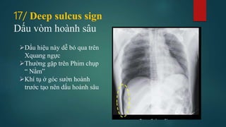 Signs in chest xray | PPTX