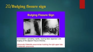 Signs in chest xray | PPTX